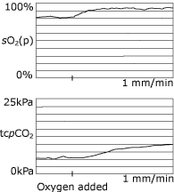 The roles of transcutaneous carbon dioxide measurement in a respiratory ...